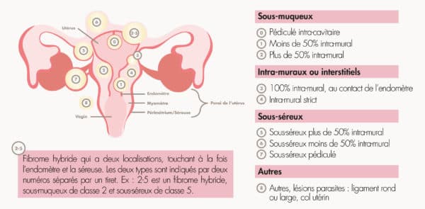 Le fibrome utérin : qu’est-ce que c’est ? - Claripharm